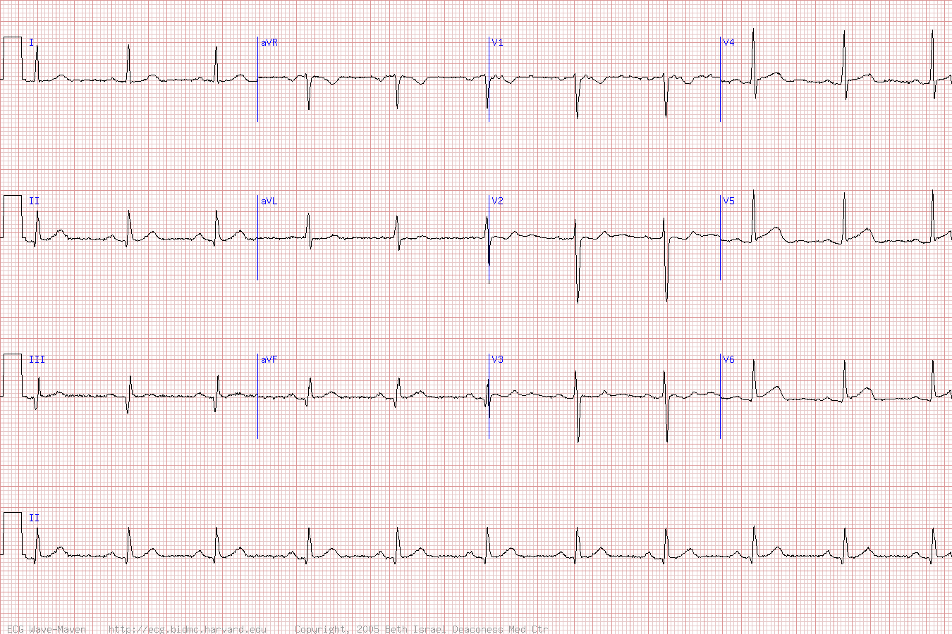 TP or PR for Baseline (example provided) : r/ECG