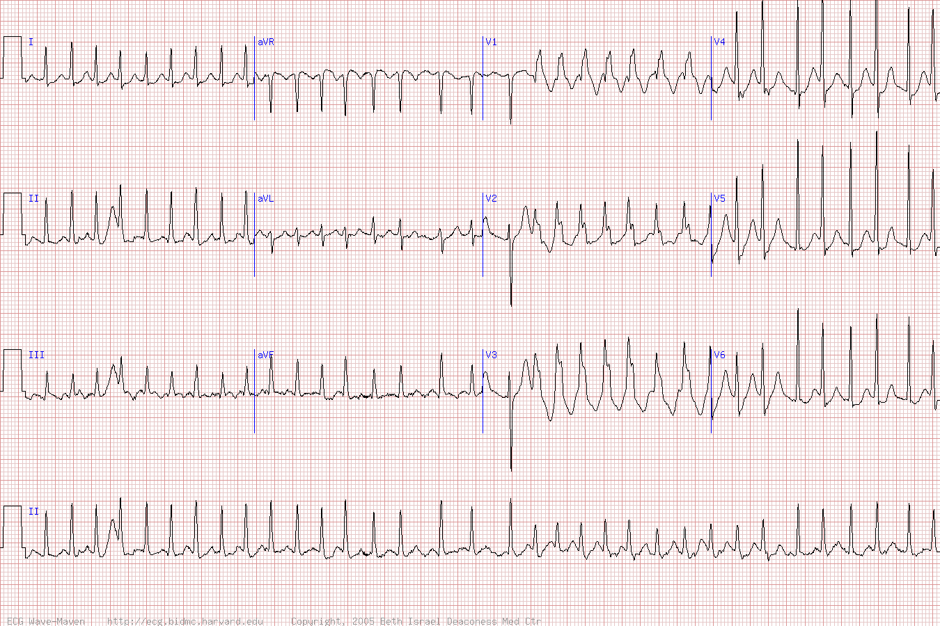 ecg.bidmc.harvard.edu on reddit.com